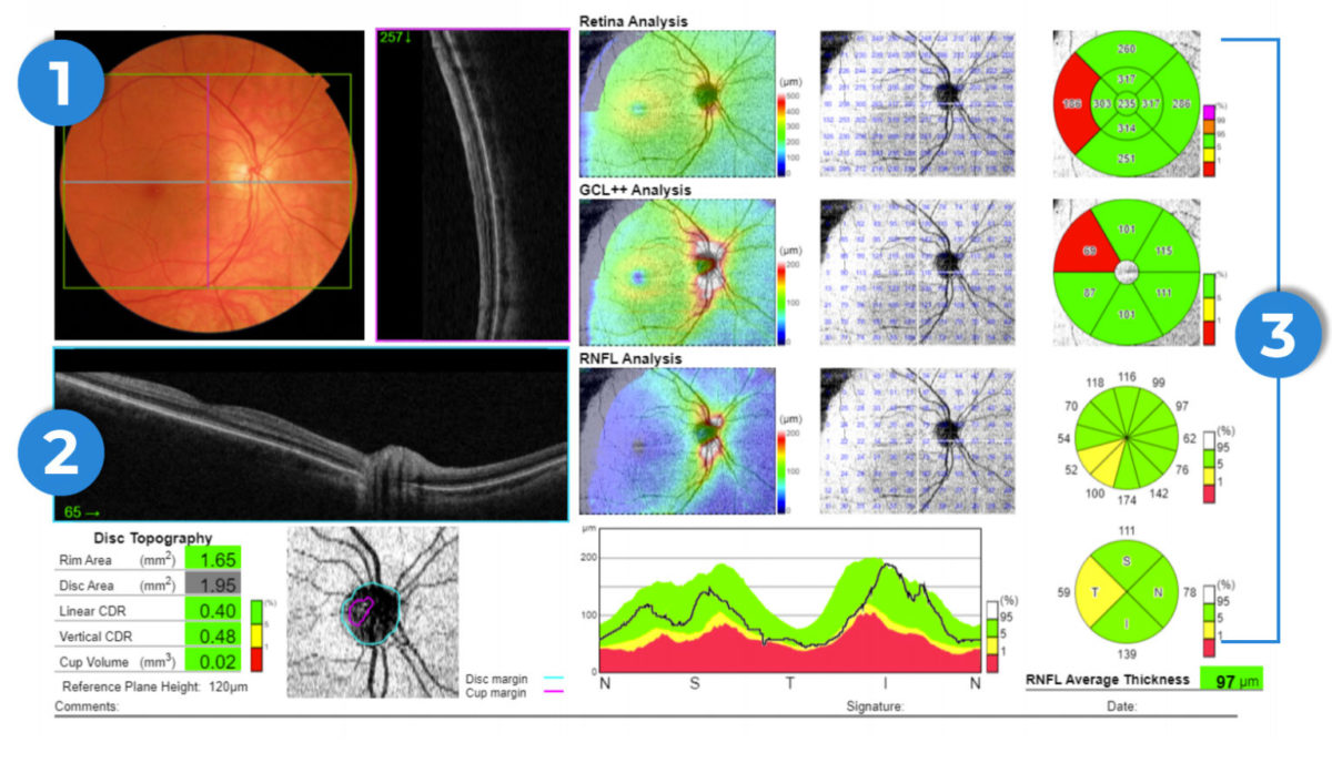 Diabetic Eye Exams in New Albany | Central Ohio Vision & Eyecare